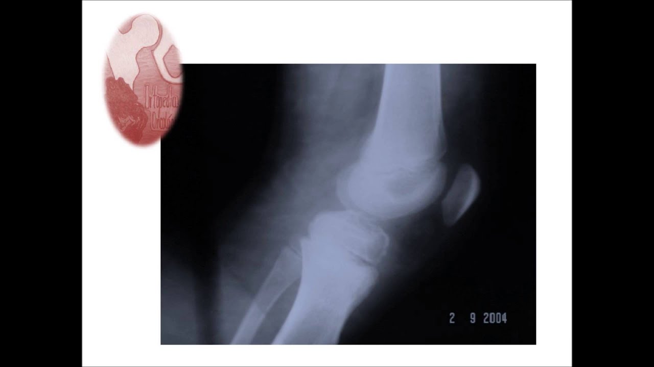 Condroblastoma. Caso clínico - YouTube