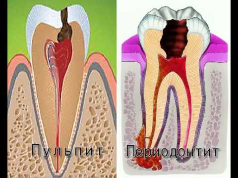 Дентал УСП 130213 - YouTube