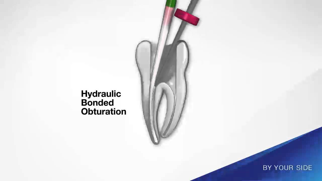 Hydraulic Bonded Obturation - YouTube