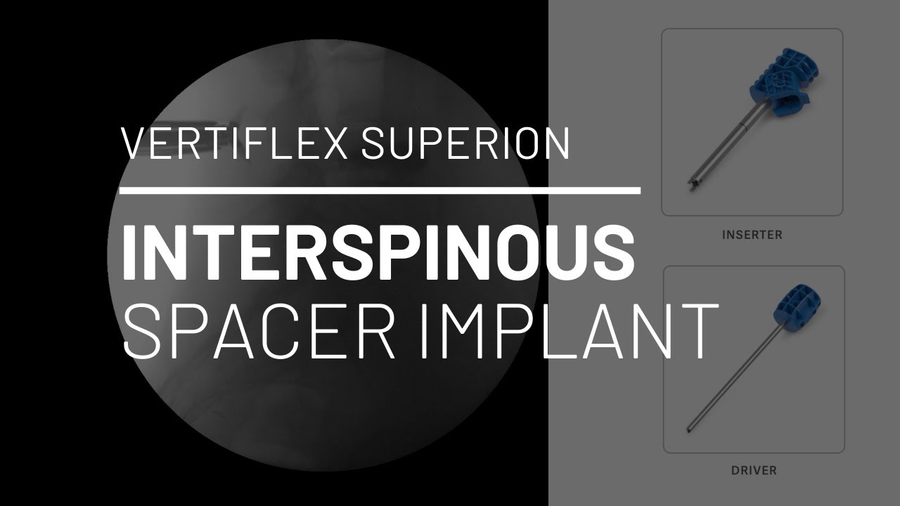 Vertiflex Superion Interspinous Spacer Implant - YouTube