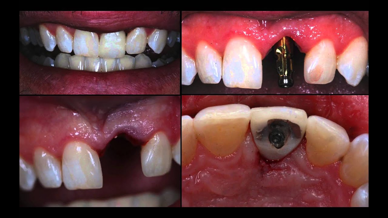 BEST Implant Flap Design PART 3 - YouTube