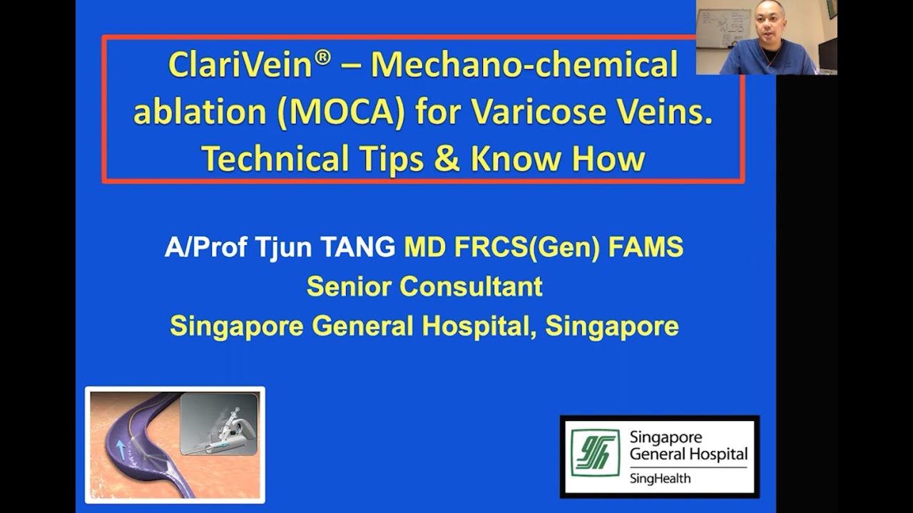 MOCA(ClariVein) for Varicose Vein Management - Technical Tip & Know-how ...