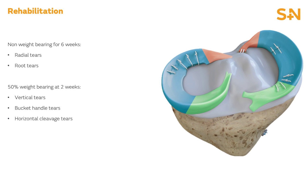 Complex Meniscus Repair with NOVOSTITCH PRO and FAST-FIX 360 - YouTube