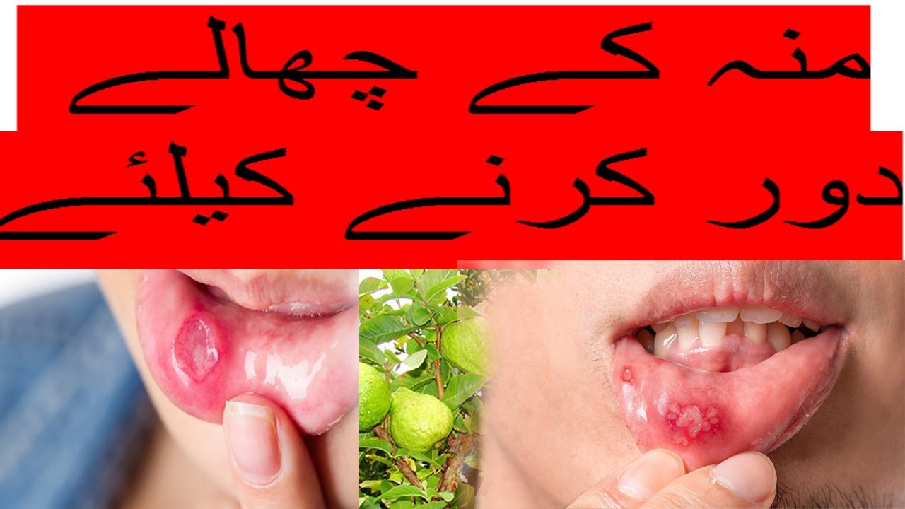 To get rid of mouth ulcers mon ke chale ka ilaj - YouTube