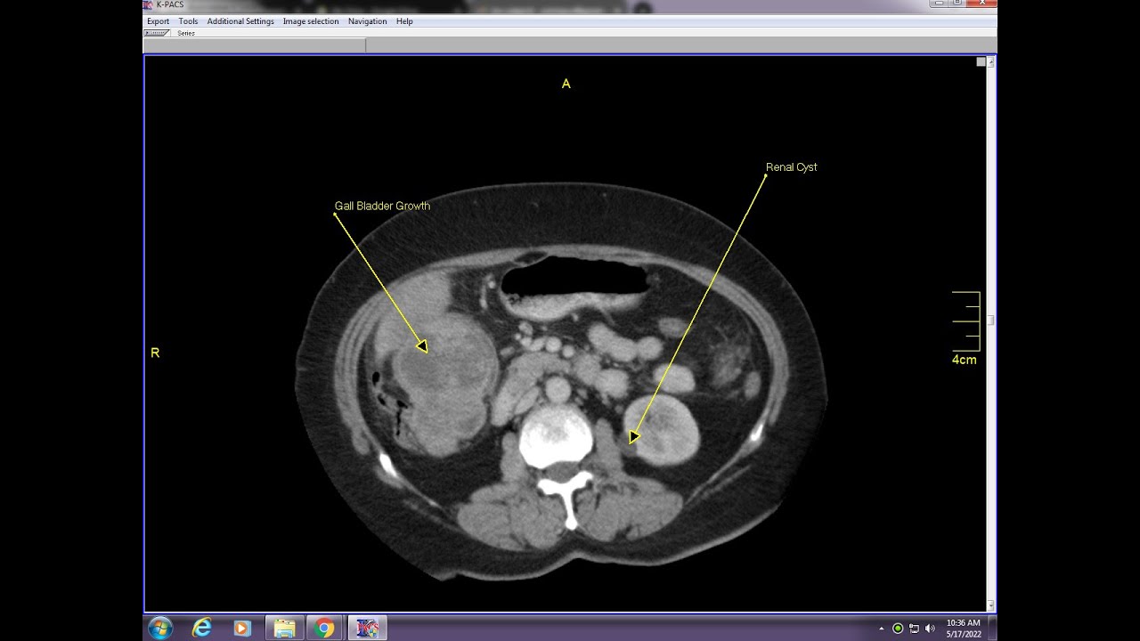 CT for Gall Bladder Growth and Renal cysts - YouTube