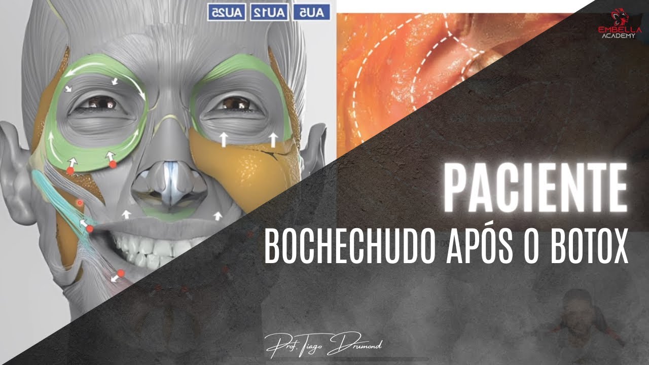 Paciente Bochechudo após o Botox - YouTube