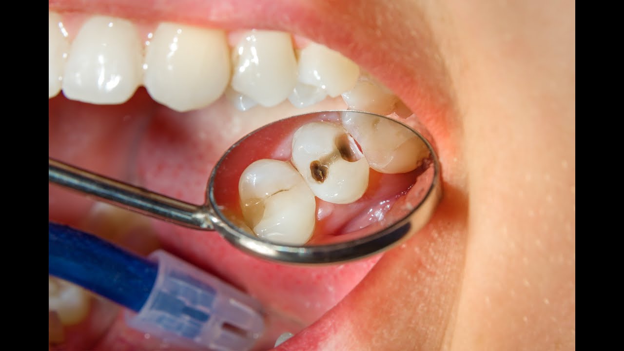 How to get rid of cavities at home. - YouTube