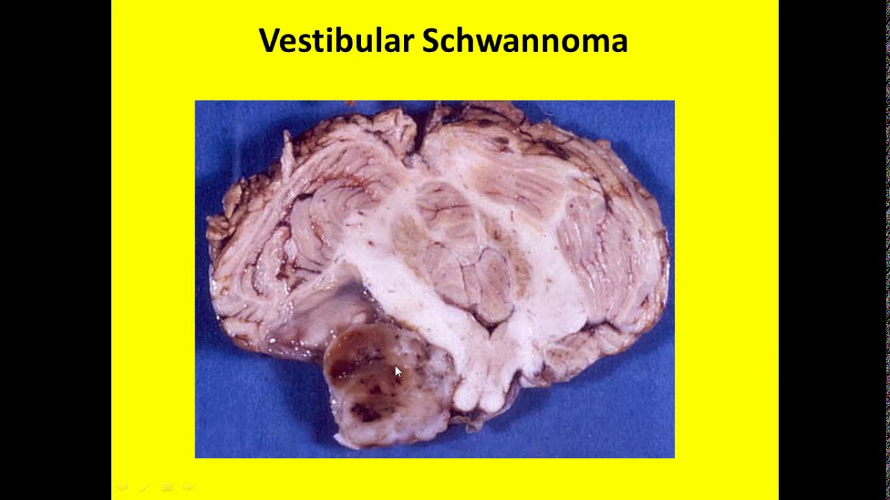 PNST part 1 - YouTube