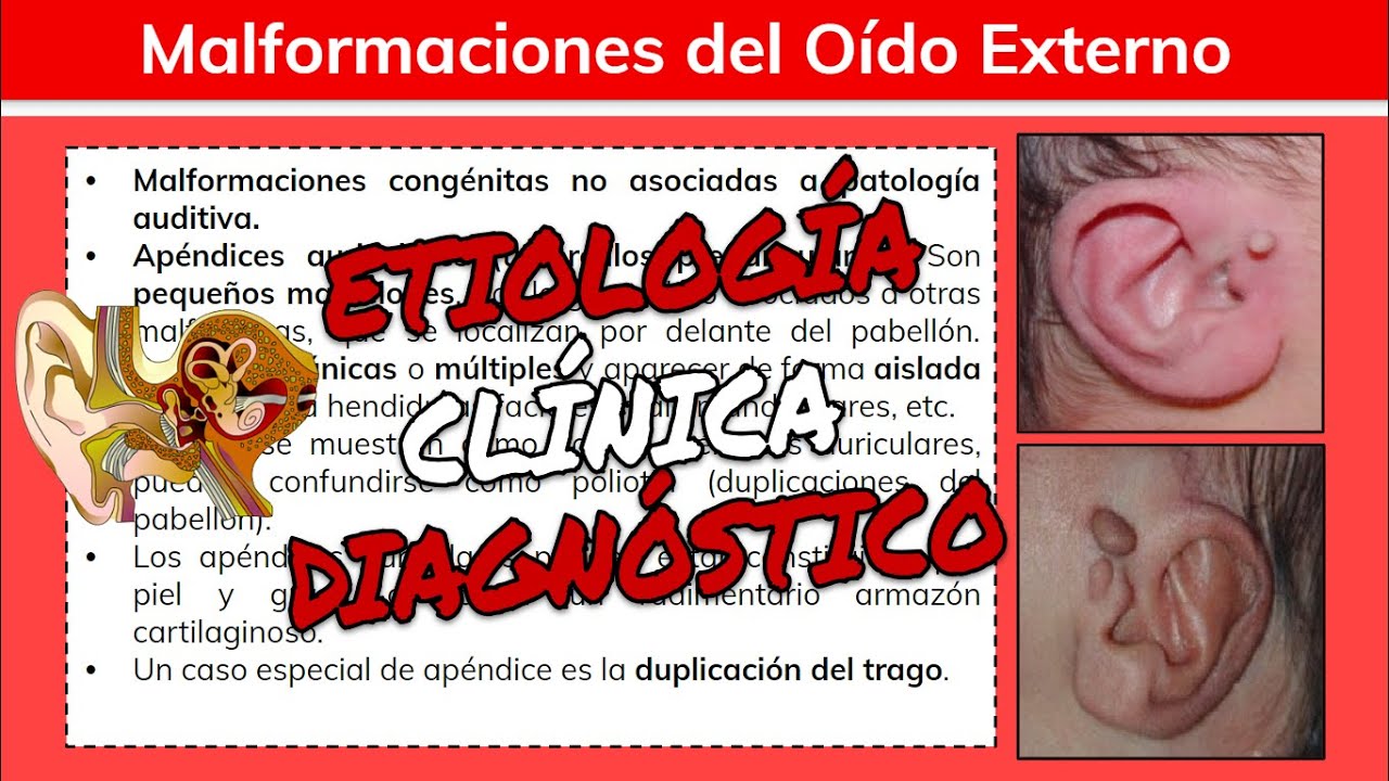 ⚕️🩺 Malformaciones del Oido Externo (Atresia, Macrotia, Microtia ...