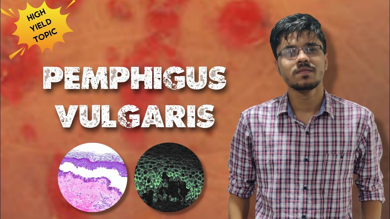 Pemphigus Vulgaris | Vesiculobullous Skin Disease | Dermatology ...