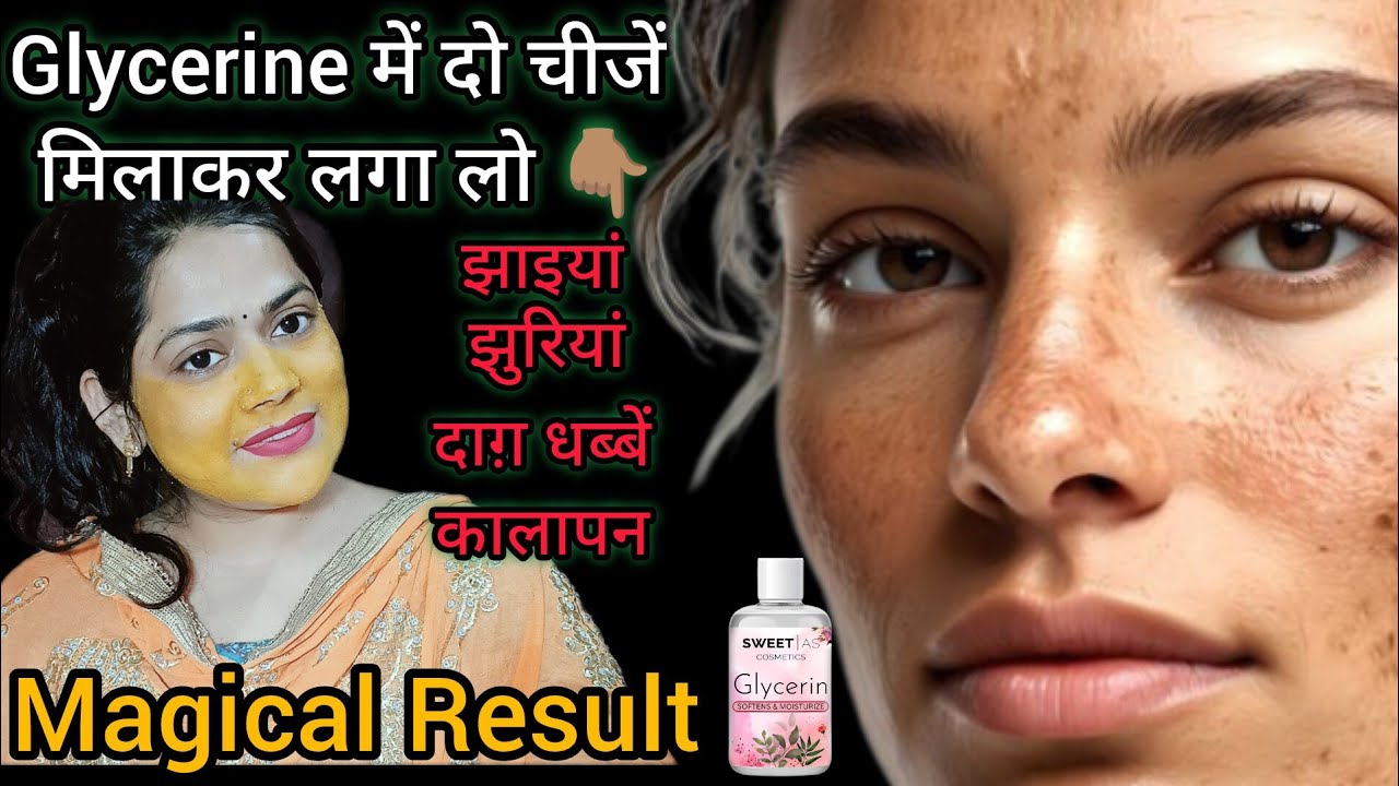 Glycerine se jhaiyan kaise hataye l How to use Glycerine on face for ...