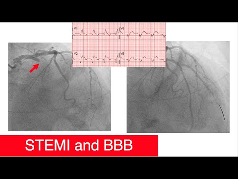 STEMIs and Left/Right Bundle Branch Blocks [Part 6] - YouTube
