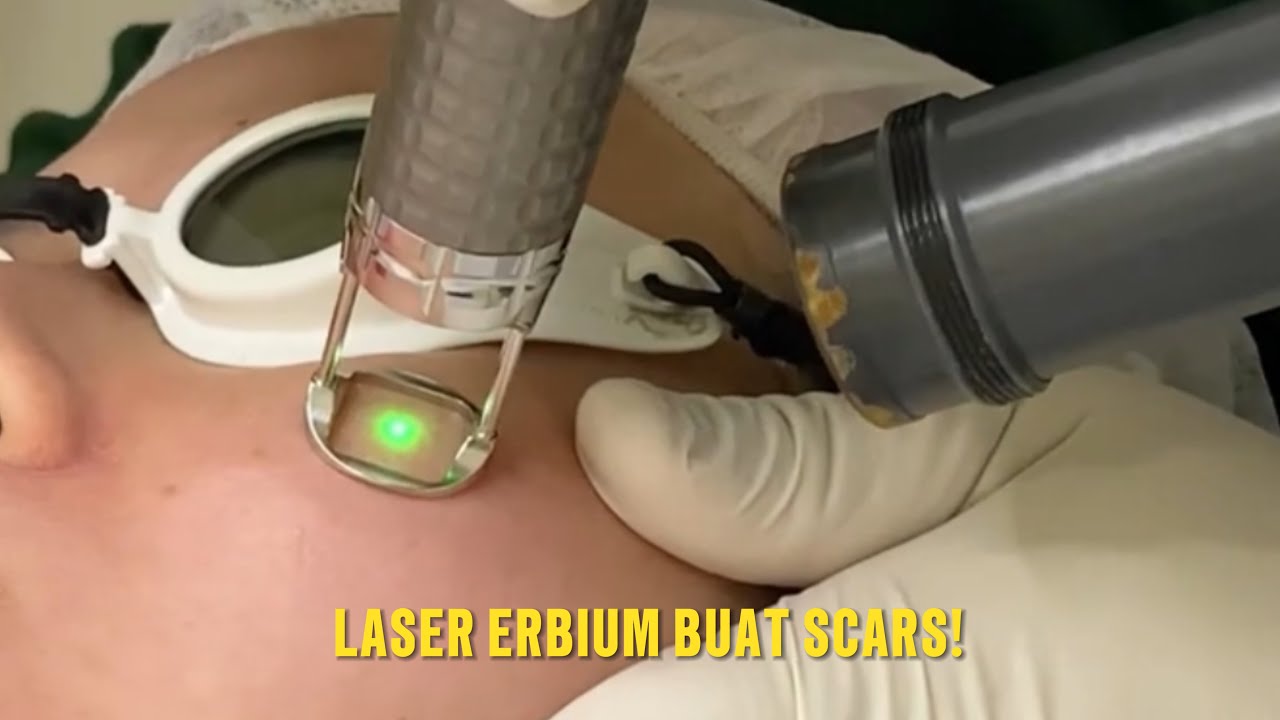 Update: LASER ERBIUM buat bopeng! - YouTube