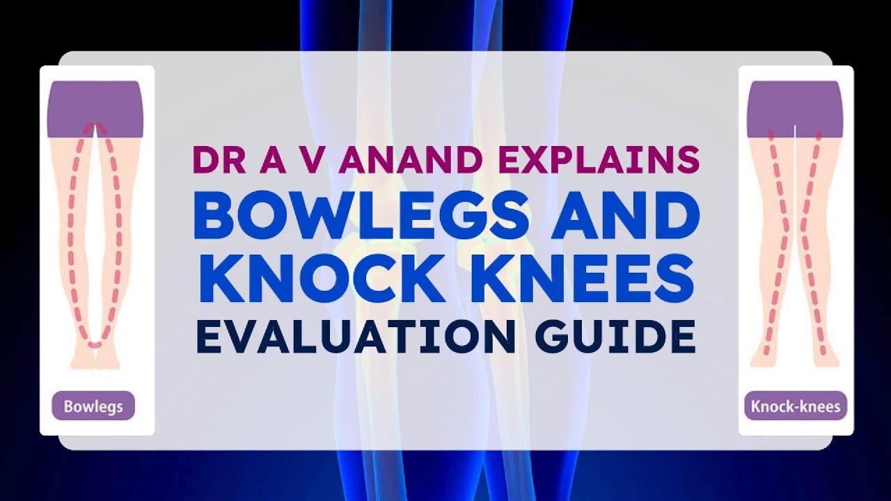 Bowlegs & Knock Knees | Dr A V Anand Explains - YouTube
