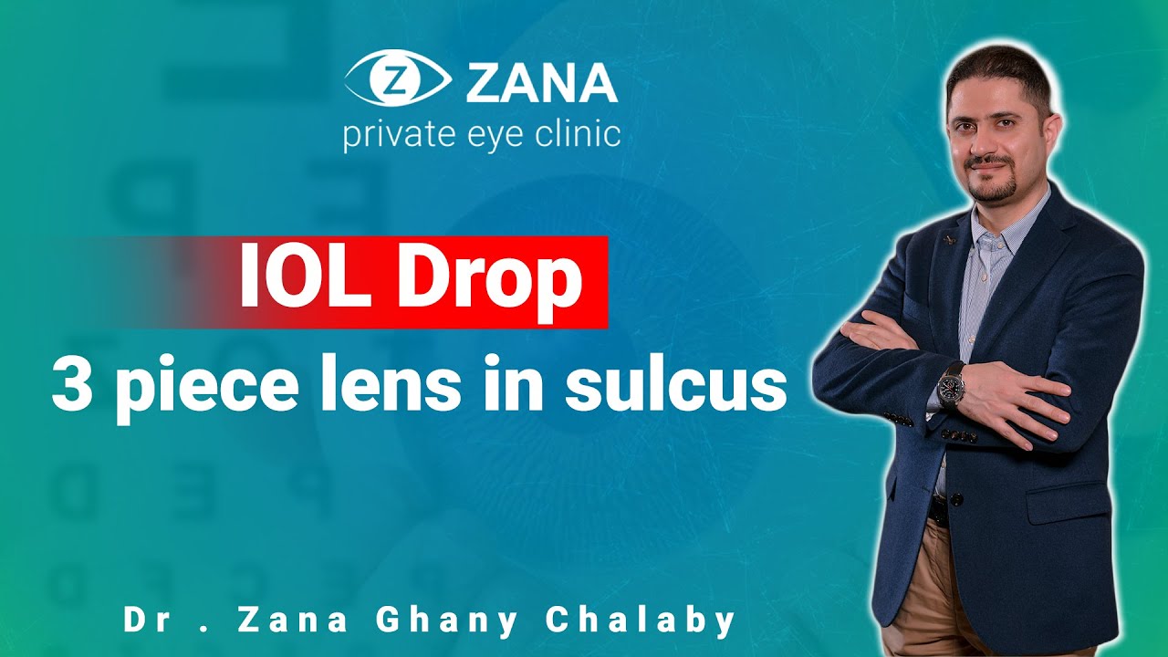 Iol drop 3 piece lens in sulcus - YouTube