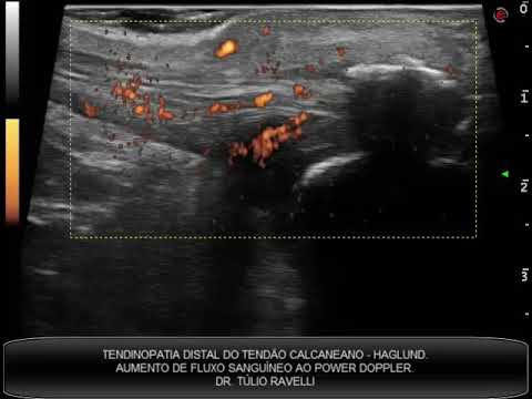 ULTRASSOM TORNOZELO - TENDINOPATIA DO TENDÃO CALCÂNEO - DOENÇA DE ...