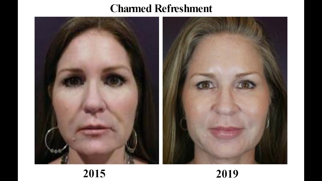 Before and After Dermal Filler Around the Mouth Immediate Results - YouTube