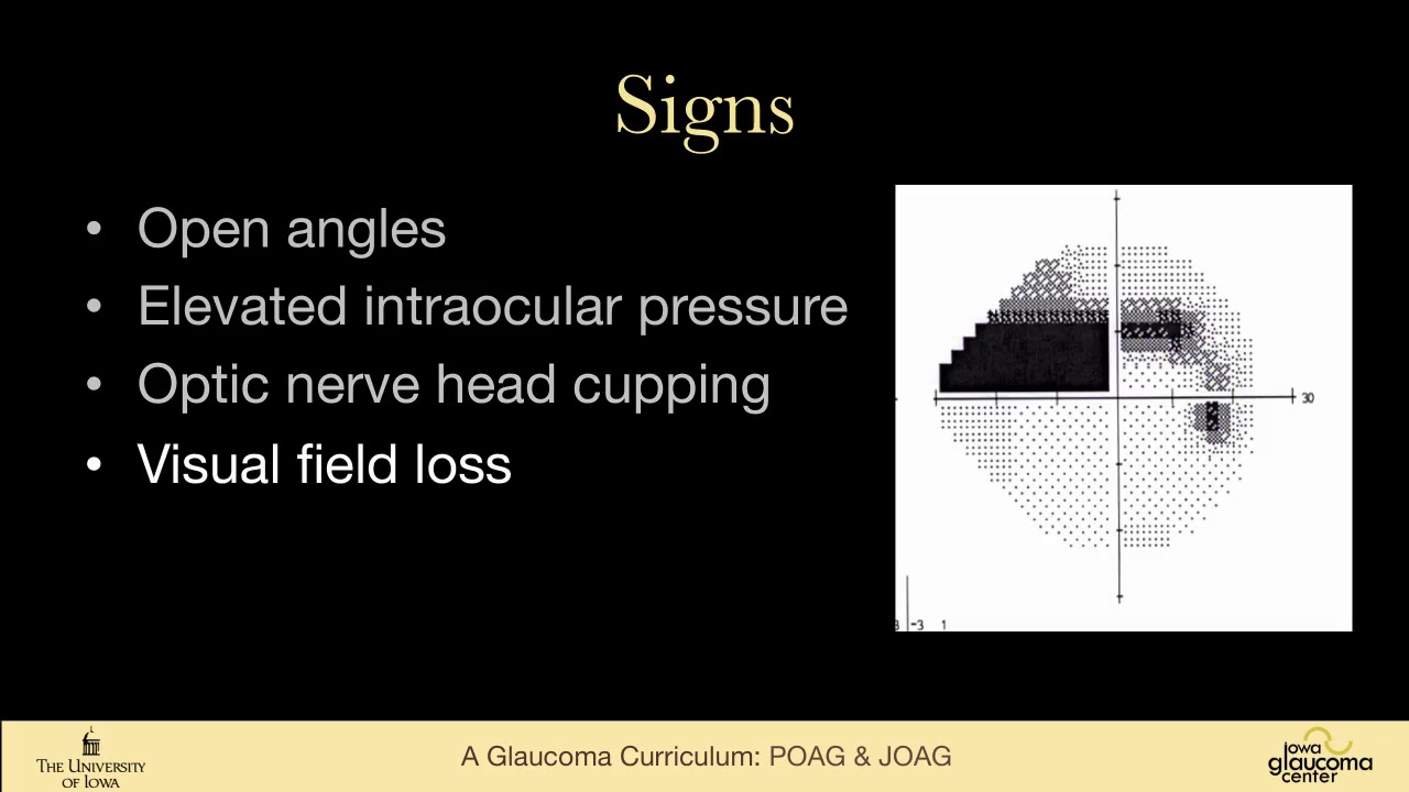 Primary Open Angle Glaucoma, Juvenile Open Angle Glaucoma (EMGT) - YouTube