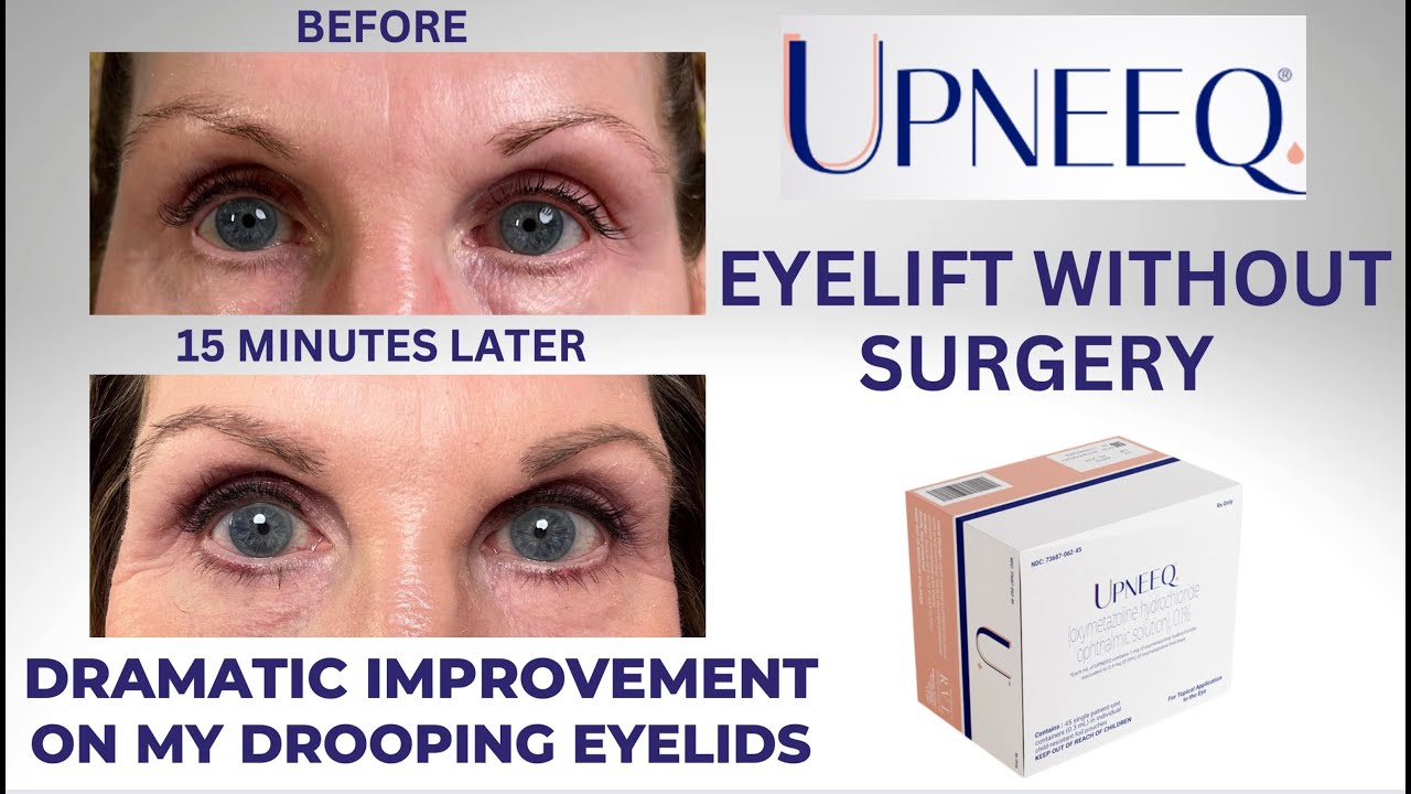How to get an eye-lift without surgery over 55 years old. NEW Upneek ...