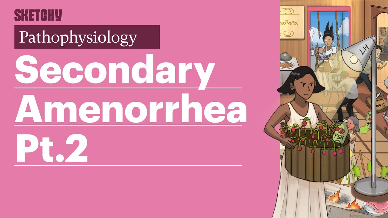 Secondary Amenorrhea Pathophysiology Part 2 Sketchy Medical secondary-amenorrhea-pathophysiology-part-2-sketchy-medical