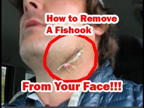 Hook Removal From Skin, How To Remove a Large Fish Hook From Your Face ...