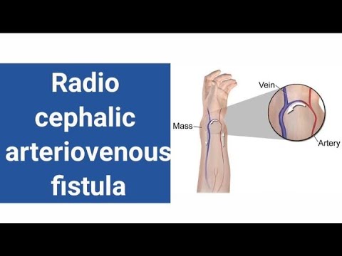 Radio cephalic arteriovenous fistula || Airen Vascular - Dr Ashish ...