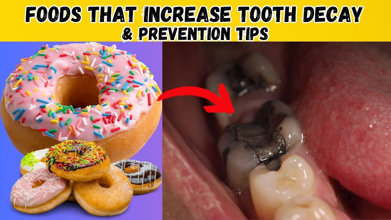 🦷 Foods That Increase Tooth Decay and How to Prevent It 🦷 - YouTube