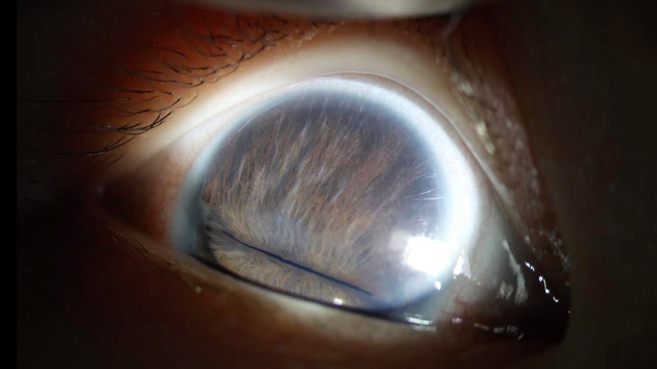 Progressive Essential Iris Atrophy in a Patient With Axenfeld-Rieger ...