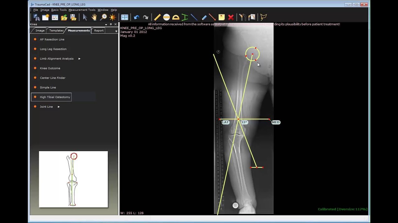 High Tibial Osteotomy in TraumaCad - YouTube