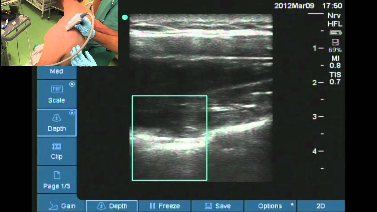 Suprascapular nerve location - YouTube