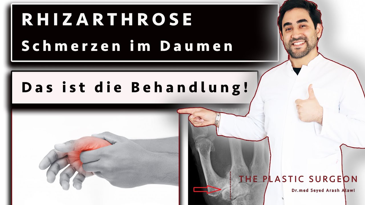 Rhizarthrose - das ist die Behandlung...| Schmerzen im ...
