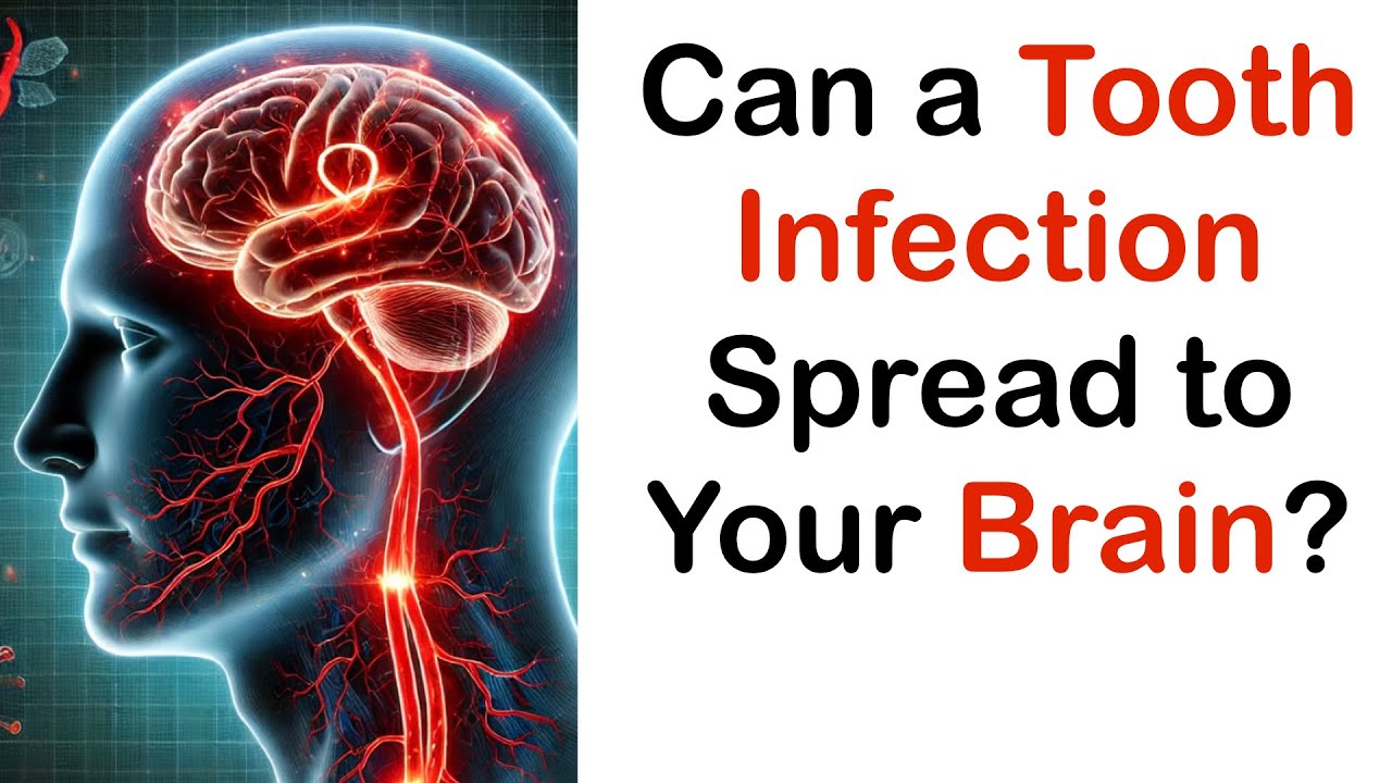 Can a Tooth Infection Spread to Your Brain? - YouTube