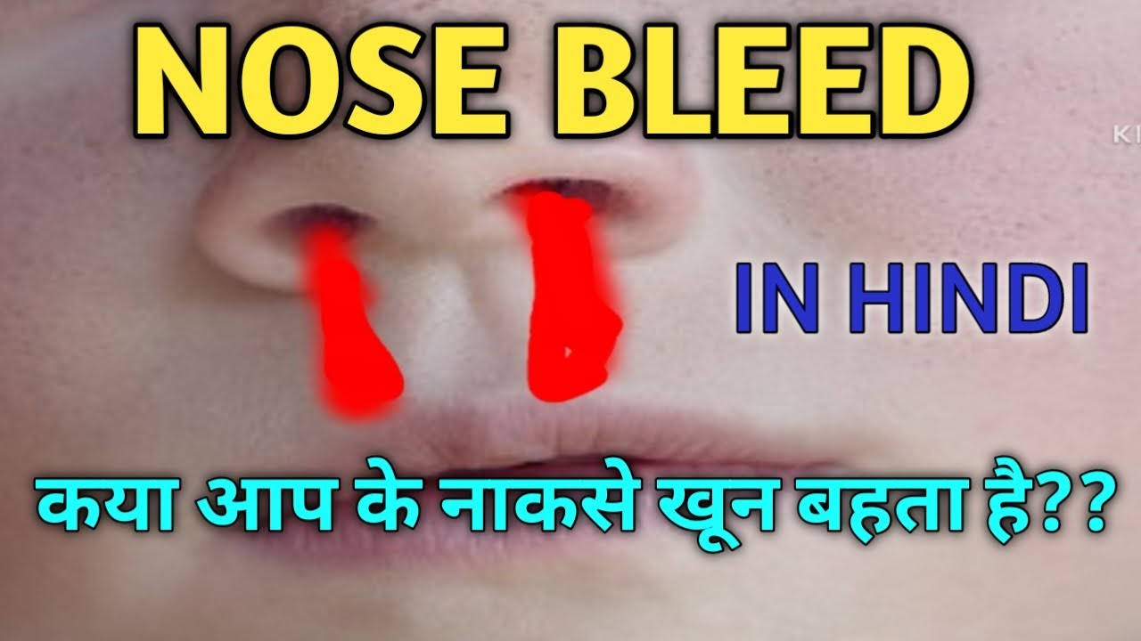 NOSE BLEED IN HINDI || क्या आपके नाकसे खून बहता है?? - YouTube
