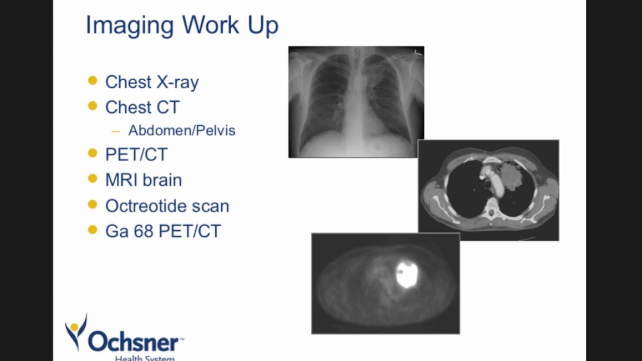 Dr Robert Ramirez Basic Of Neuroendocrine Of The Lungs June 2016 Youtube