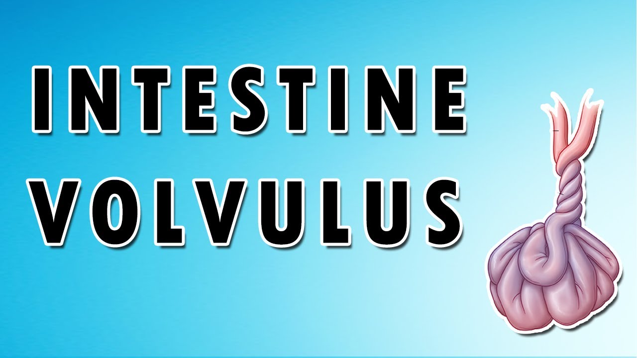 Volvulus and Intussusception - YouTube