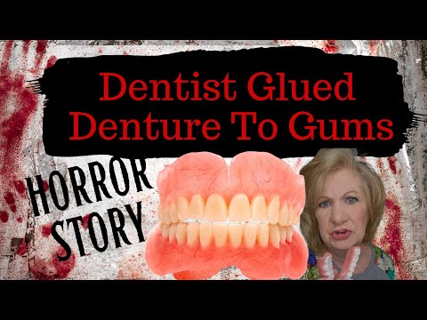 Dentures Glued to Gums over Full Mouth Extraction - YouTube