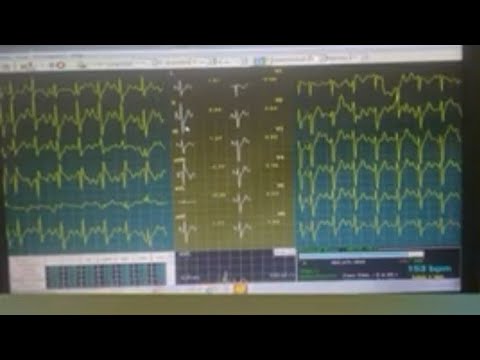 What is TMT || treadmill test || tmt test kya hai #heart #doctor # ...
