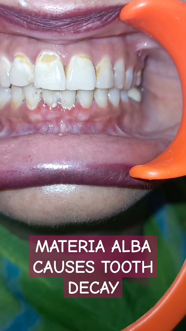 MATERIA ALBA @dentalcafe4331 - YouTube
