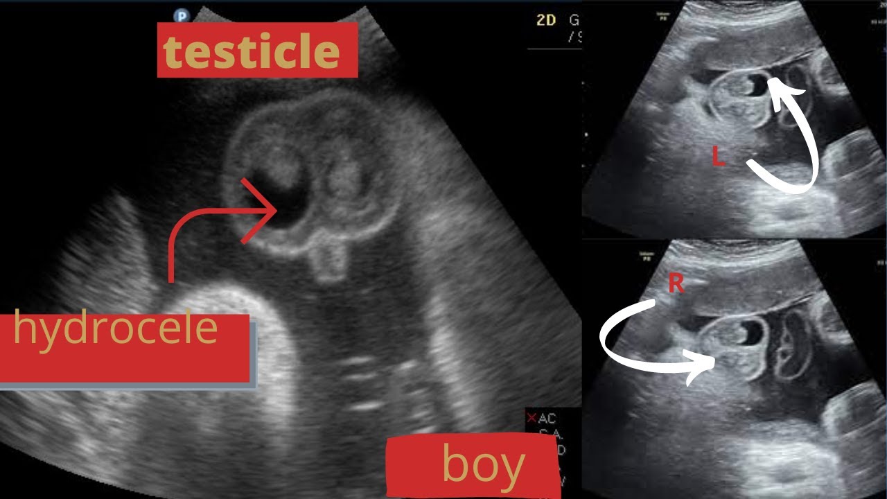 Obstetric Ultrasound Normal Vs Abnormal Images Fetal,, 47% OFF