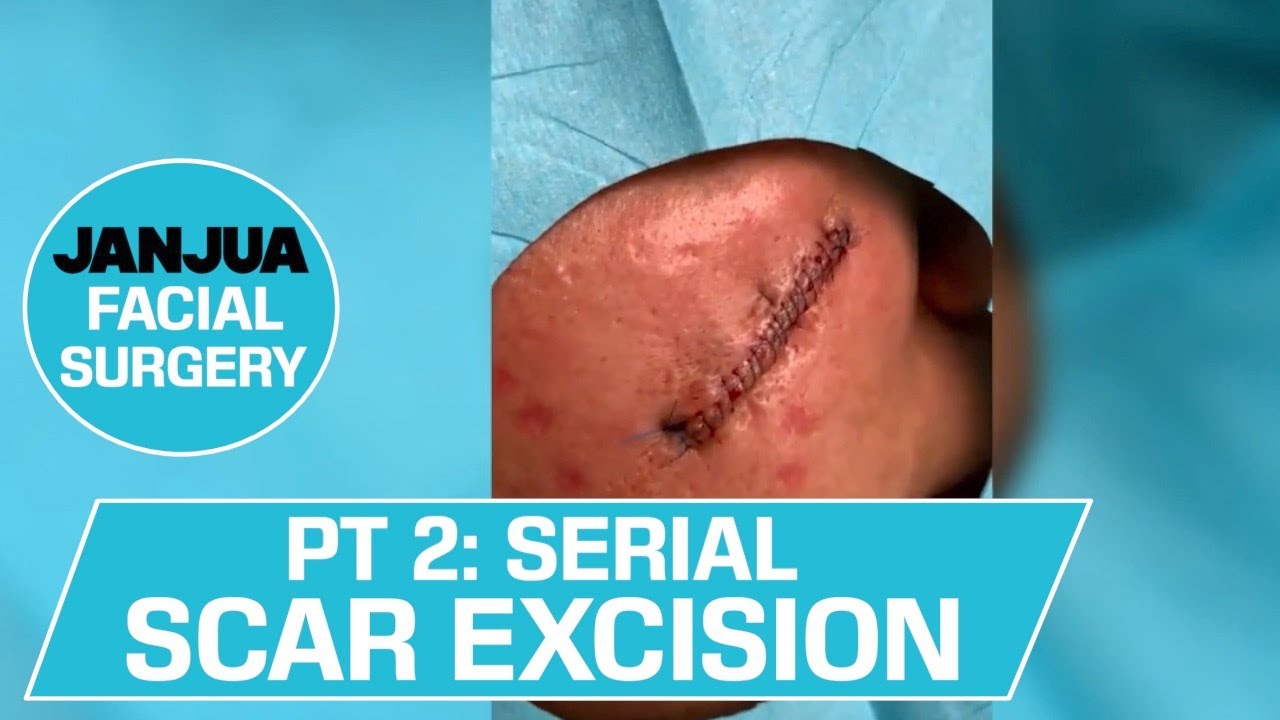 PART 2: SERIAL SCAR EXCISION ON THE RIGHT CHEEK - DR. TANVEER JANJUA ...
