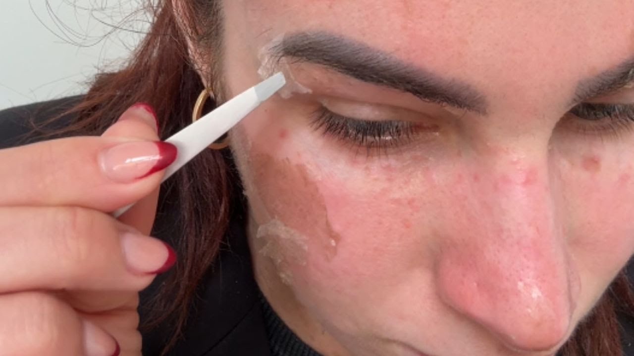 Satisfying Skin-Peeling Process After Elaine Brennan Chemical Peel ...