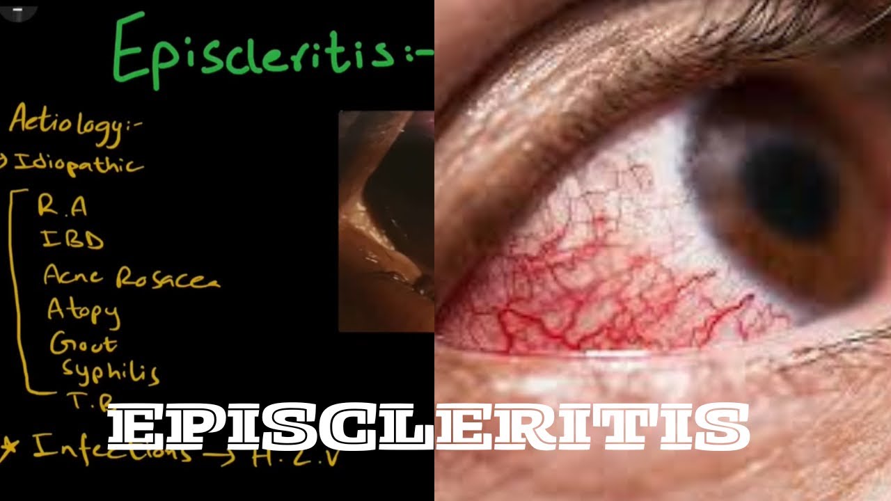 Episcleritis | Aetiology , pathogenesis , clinical features , treatment - YouTube