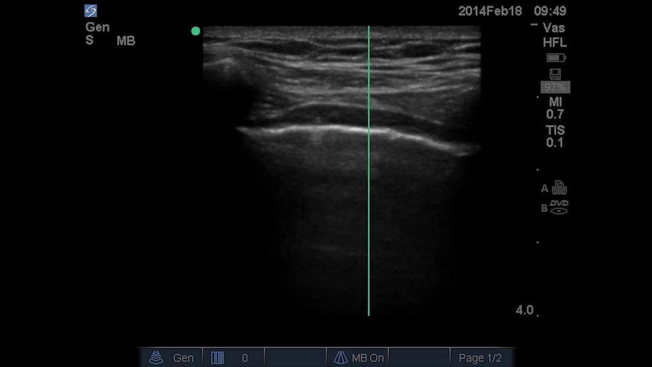 Asvide: Lung sliding is present in healthy lung (obtained from left ...