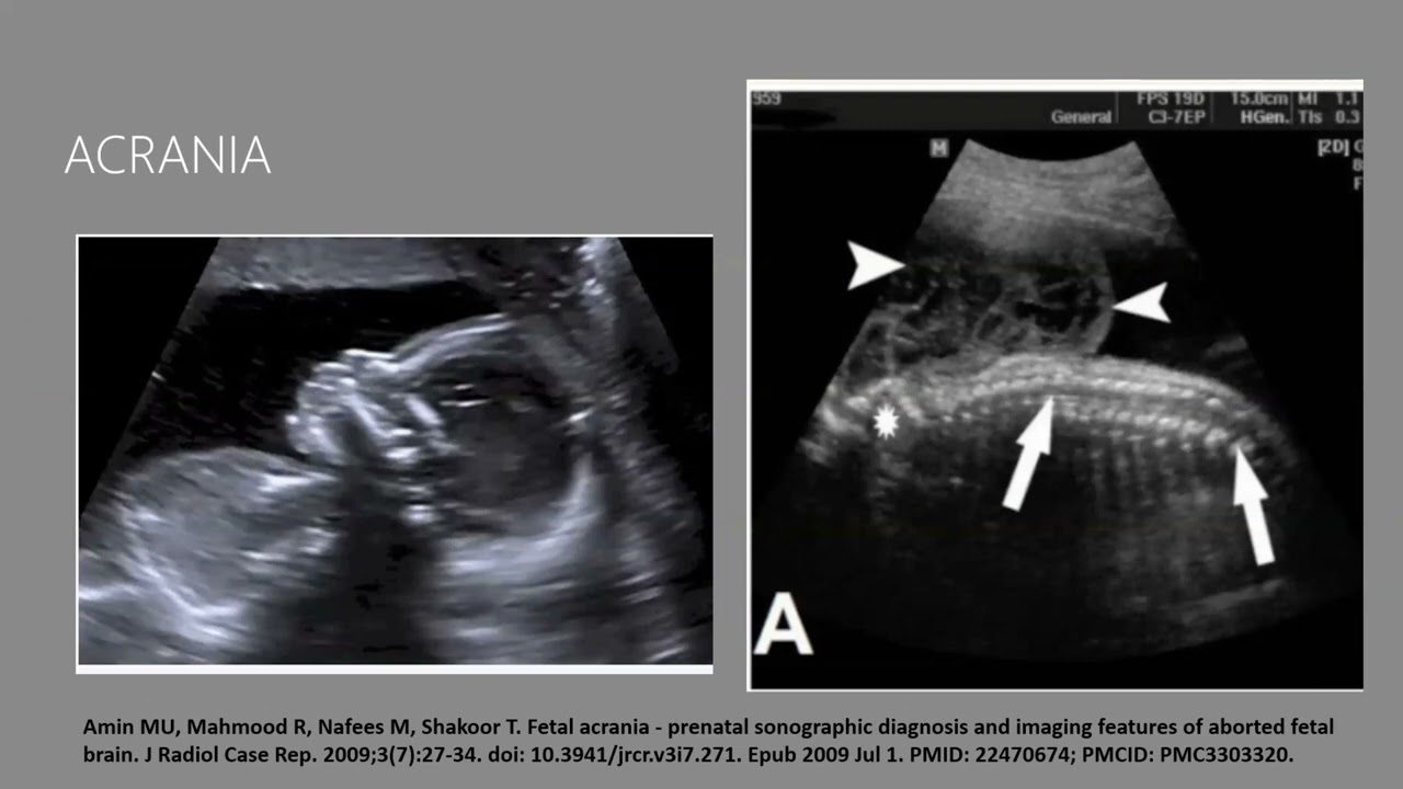 Ultrasound in Detection of Fetal Malformations - YouTube