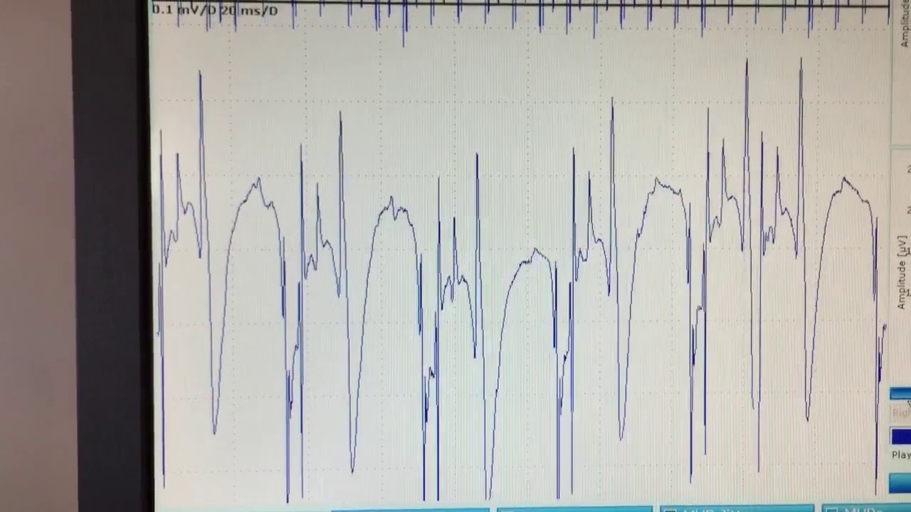 complex repetitive discharge - YouTube