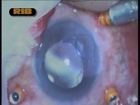 An unusual case of "Floaters" - YouTube