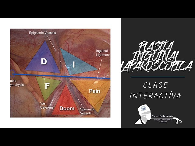 Anatomia Inguinal Laparoscopica