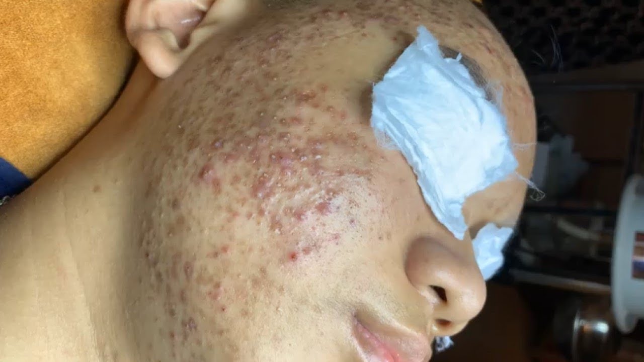 Make your Acne Treatment | Acne spa 178 | Acne spa Treatment - YouTube