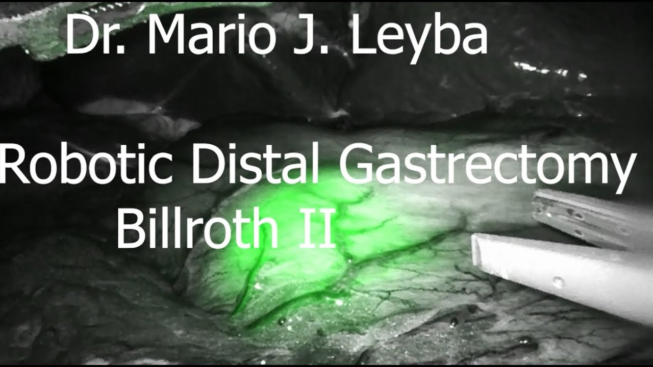 Robotic distal gastrectomy with Billroth II - YouTube