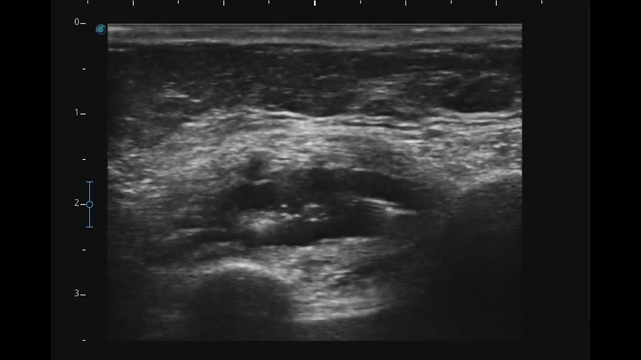 External Oblique Intercostal Fascial Plane Block - YouTube